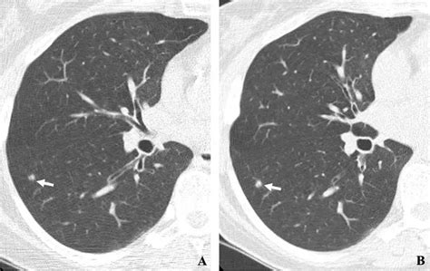 Screening Sharply Improves Lung Cancer Long T Eurekalert