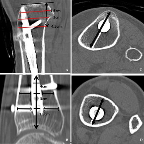 CT Images In Patients A Sagittal Image Of The Proximal Tibia At Three Download Scientific