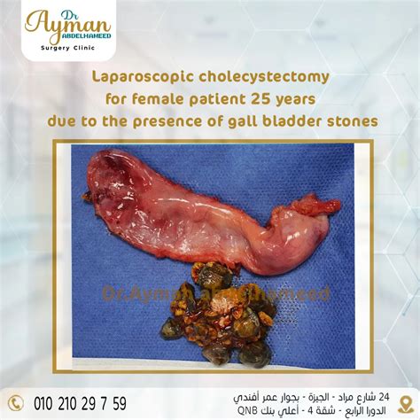 Laparoscopic Cholecystectomy Drayman Abd Elha