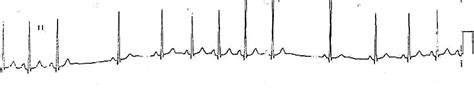 Sinoatrial Exit Block • Litfl • Ecg Library Diagnosis
