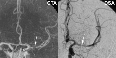 How Accurate Is CT Angiography In Evaluating Intracranial Atherosclerotic Disease Stroke