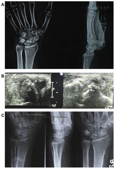 Ulnar Deviation X Ray