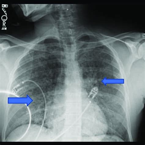 Blue Arrows Showed Diffuse Reticulonodular Opacities Download