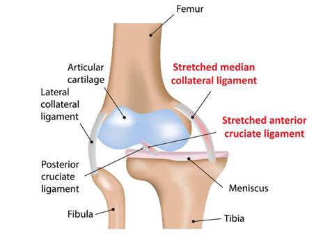 Knee Dislocation Reduction