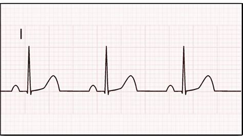 3 Lead Ecg Nursing Unraveled