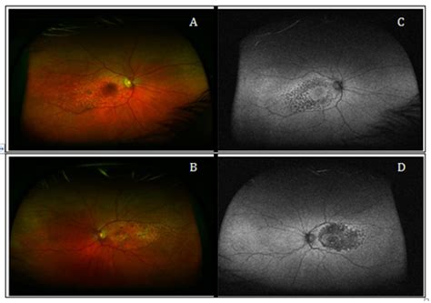 Characteristics Of Late Onset Retinal Degeneration L Ord Medcrave