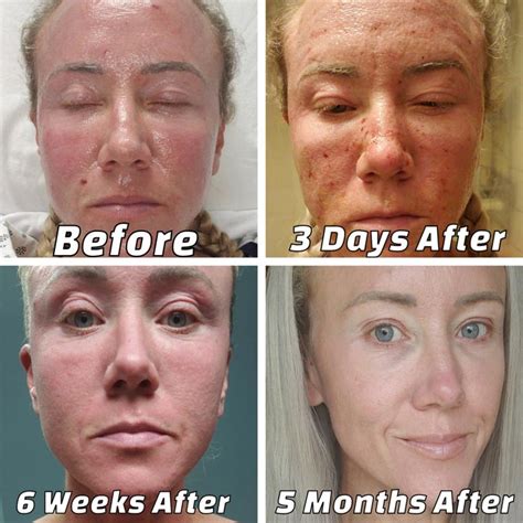 Co2 Fractional Laser Treatment Skin Texture Improvement