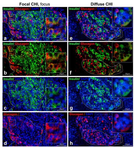 Cells Co Producing Insulin And Glucagon In Congenital Hyperinsulinism