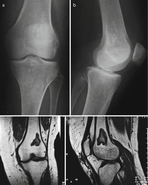 Bone Infarct Musculoskeletal Key