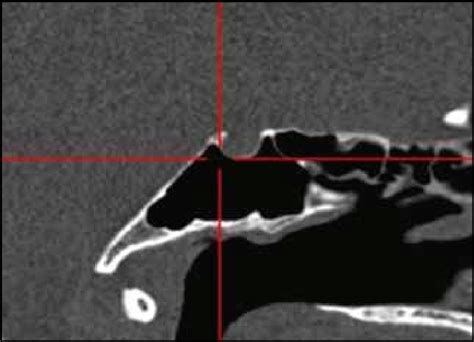 Complete Sellar Type Pneumatization Of The Sphenoid Sinus Download