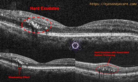 Oct Hard Exudates Highly Reflective Lesions In The Eye