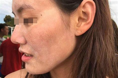 日光性皮炎面部症状图片