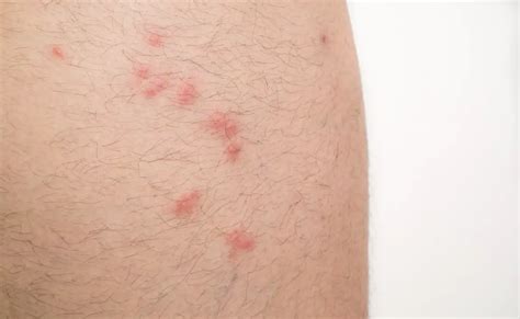 What Are The Symptoms Of An Allergic Reaction To A Bed Bug Bite