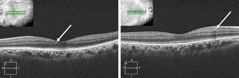 West African Crystalline Maculopathy A Case Report Ocl