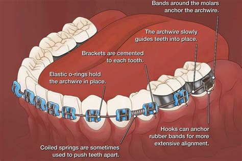 Bracket Braces