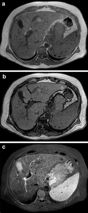 Regenerative Nodules In Liver Pacs