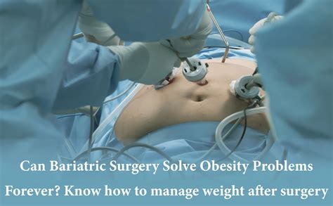 Can Bariatric Surgery Solve Obesity Problems Forever Know How To Manage Weight After Surgery