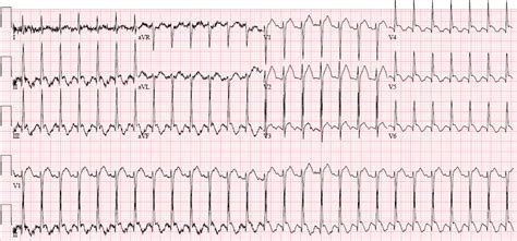 Inferolateral St Elevation Vomiting And Elevated Troponin Dr Smiths Ecg Blog