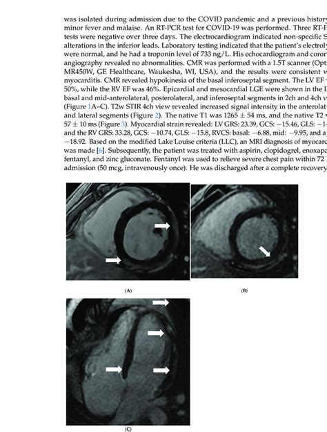 Cmr Imaging Demonstrates Epicardial Type Of Late Gadolinium Enhancement
