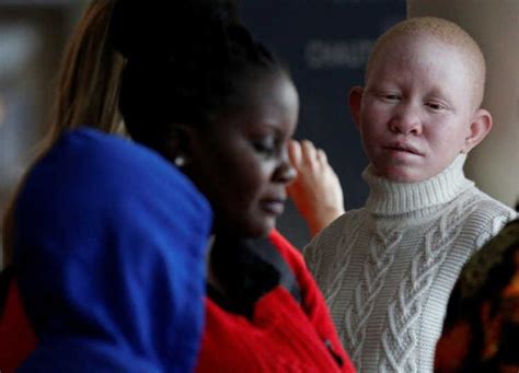 South Africa Persons With Albinism In Need Of Protection