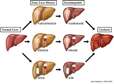 Simultaneous Metabolic And Alcohol Associated Fatty Liver Disease Smafld And Simultaneous