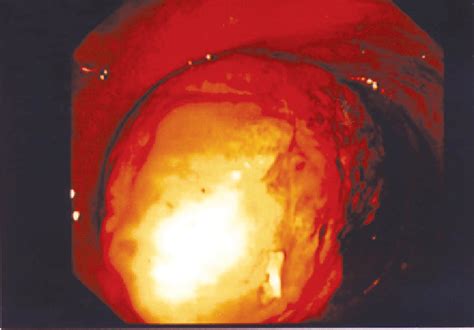Figure Endoscopic End On View Of Intussusception Note The Appearance