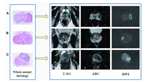 Figure 2 From Deep Learning In Prostate Cancer Diagnosis Using