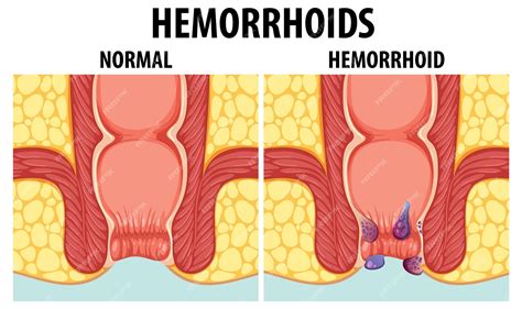 Healthy Anus Vs Hemorrhoids