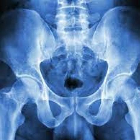 Xray Of Pelvis Ap Test 1s Pharma Xonline