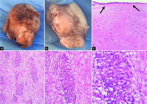 A And B Polypoid Mass C Stratified Squamous Epithelium Arrows