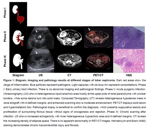 Clinical And Pathological Features Of Lobar Nephronia In Renal Allograft Atc Abstracts
