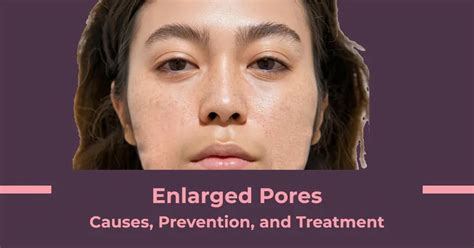 Enlarged Pores Causes Prevention And Treatment Guide