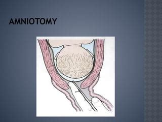Complications During Labor And Birthpptx