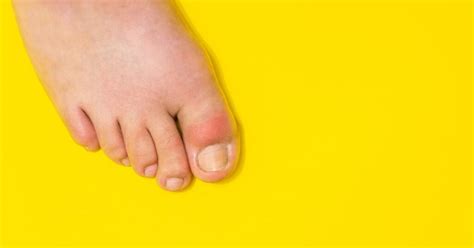 Hálux Rígido Quando Operar E Como Tratar