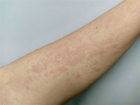 Maculopapular Rash Maculopapular Rash Causes Appearance And