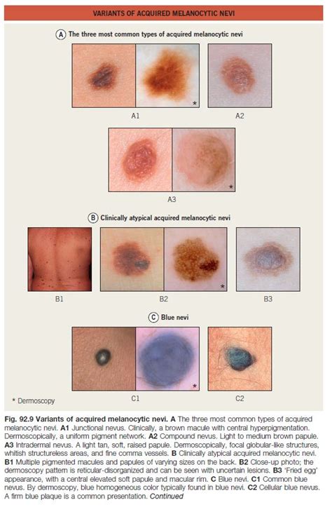 Congenital Melanocytic Nevus Compound Type