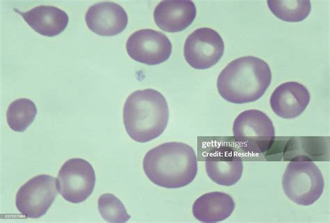 Pernicious Anemia Cells