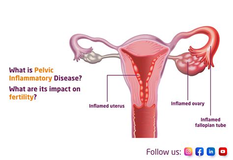 Pelvic Inflammatory Disease Pelvic Inflammatory Disease Causes