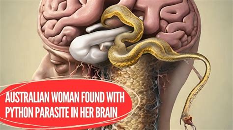 Australian Woman Found With Python Parasite In Her Brain Youtube