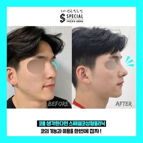스페셜이비인후과 남자코성형은 라인을 어떻게 잡느냐가 중요합니다 외적인 부분 뿐만 아니라 코의 구조와