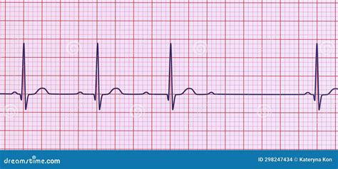An Ecg With 2nd Degree Av Block 3d Illustration Royalty Free Cartoon