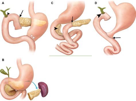 Imaging After Pancreatic Surgery Expected Findings And Postoperative