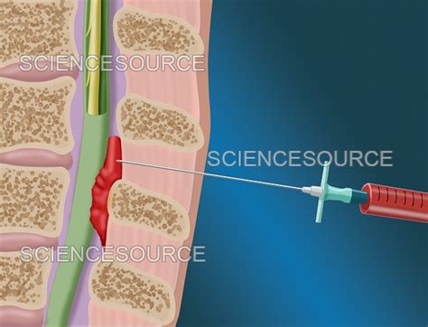 Photograph Epidural Blood Patch Procedure Illust Science Source Images Photograph Epidural Blood Patch Procedure Illust Science Source Images