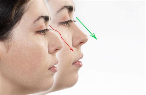 Facial Feminization Surgery 5 Intriguing Nose Transformations Revealed