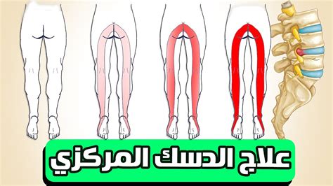 علاج الانزلاق او الدسك المركزي متلازمة ذيل الفرس ألم وخدر وتنميل في