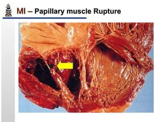 Pathology Of Myocardial Infarction Ppt