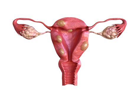 Pictures Of Fibroids Usa Fibroid Centers