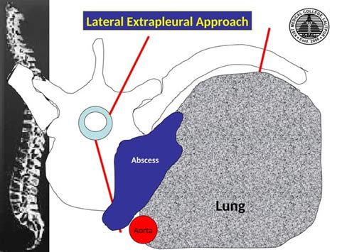 7 Presentation Spinal Tuberculosis Modified Ppt