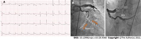 St Segment Elevation Myocardial Infarction In Kawasaki Disease A Case