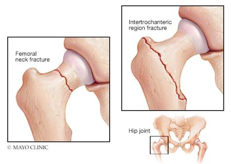 Osteoporosis Hip Fracture